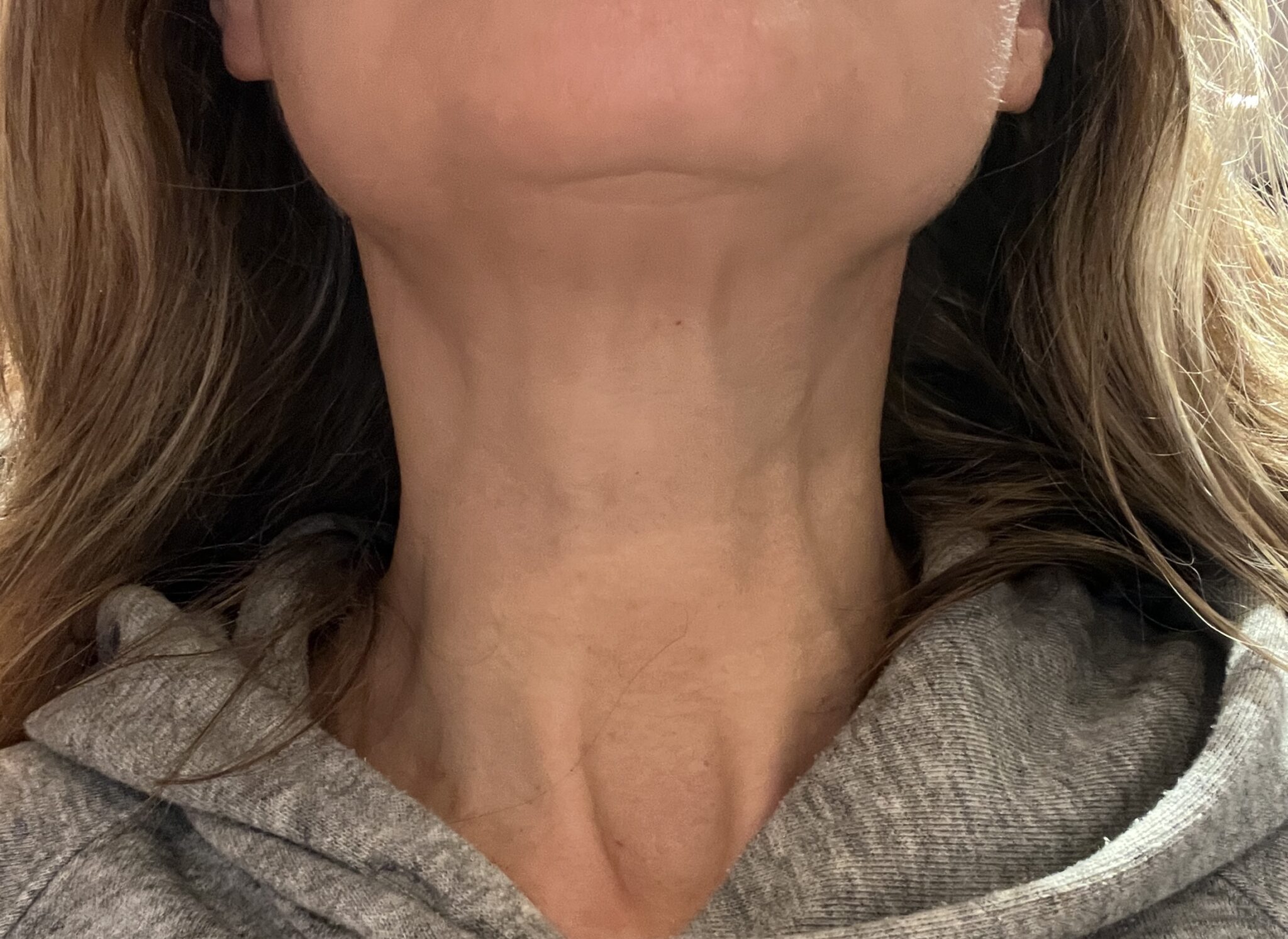 Exercises to tackle double chin and loose neck skin - Honest Voice